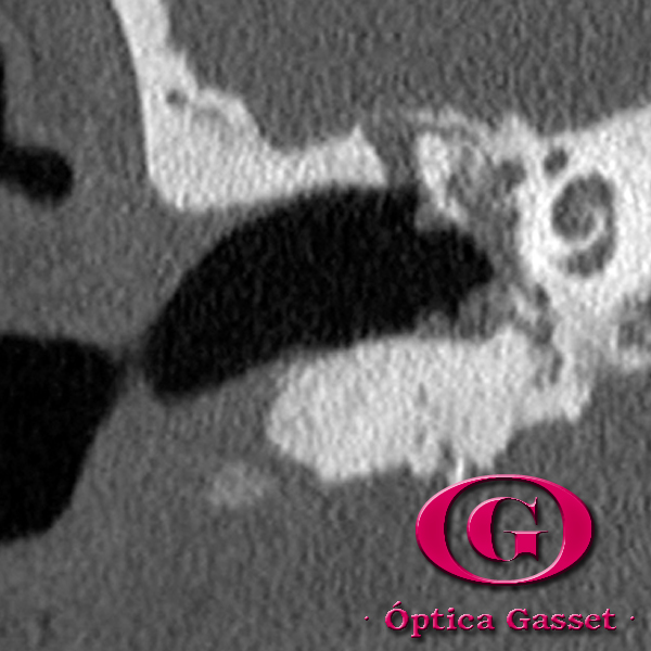 Colesteatoma, una alteración de la membrana del oído medio